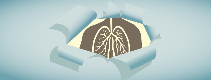 Bullectomy as a Treatment for Severe COPD