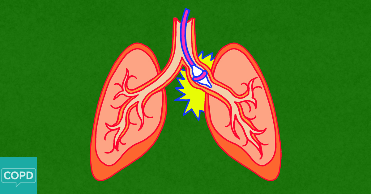 Targeted Lung Denervation for COPD Treatment